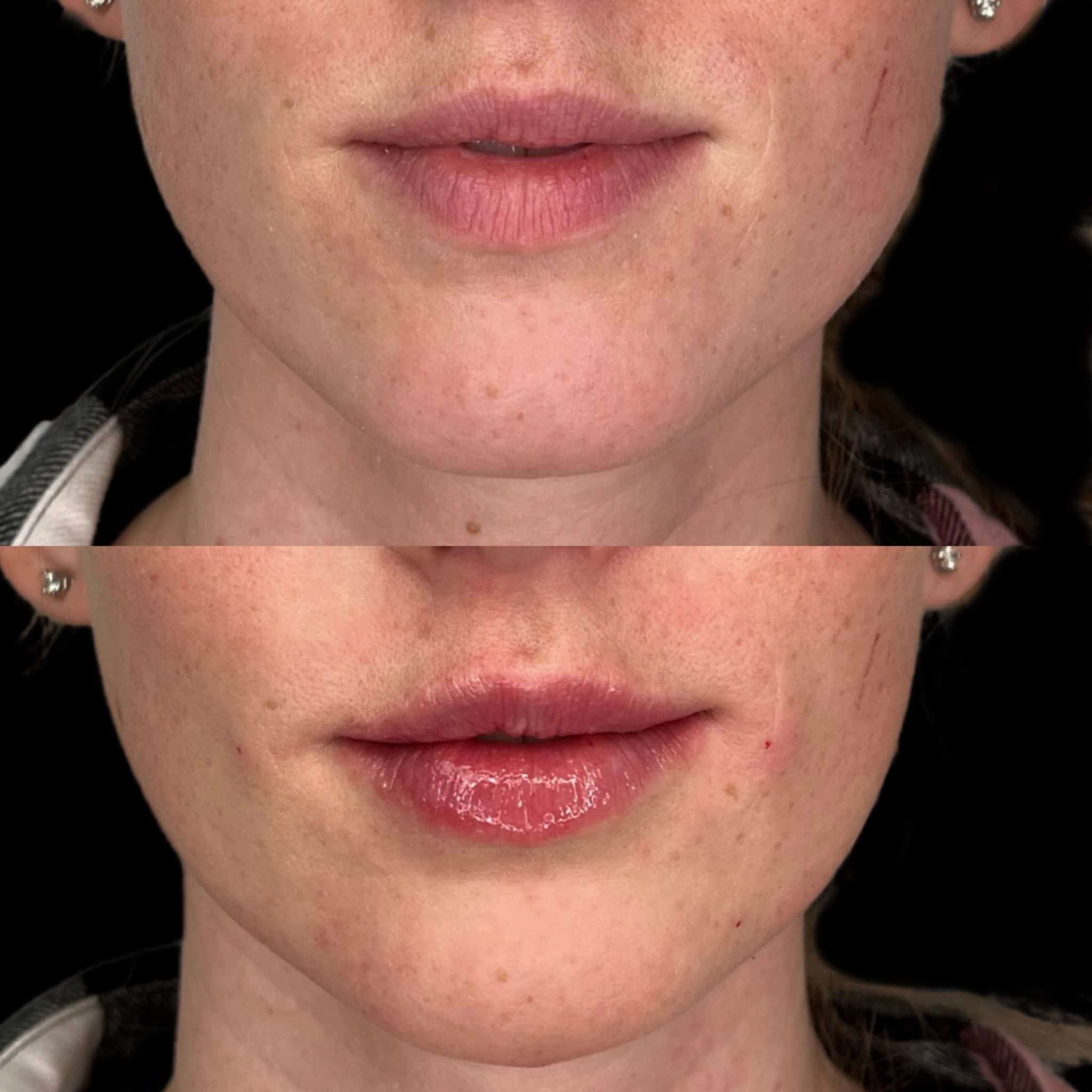 Before And After Images | ReLux Medical Spa In Akron, Ohio